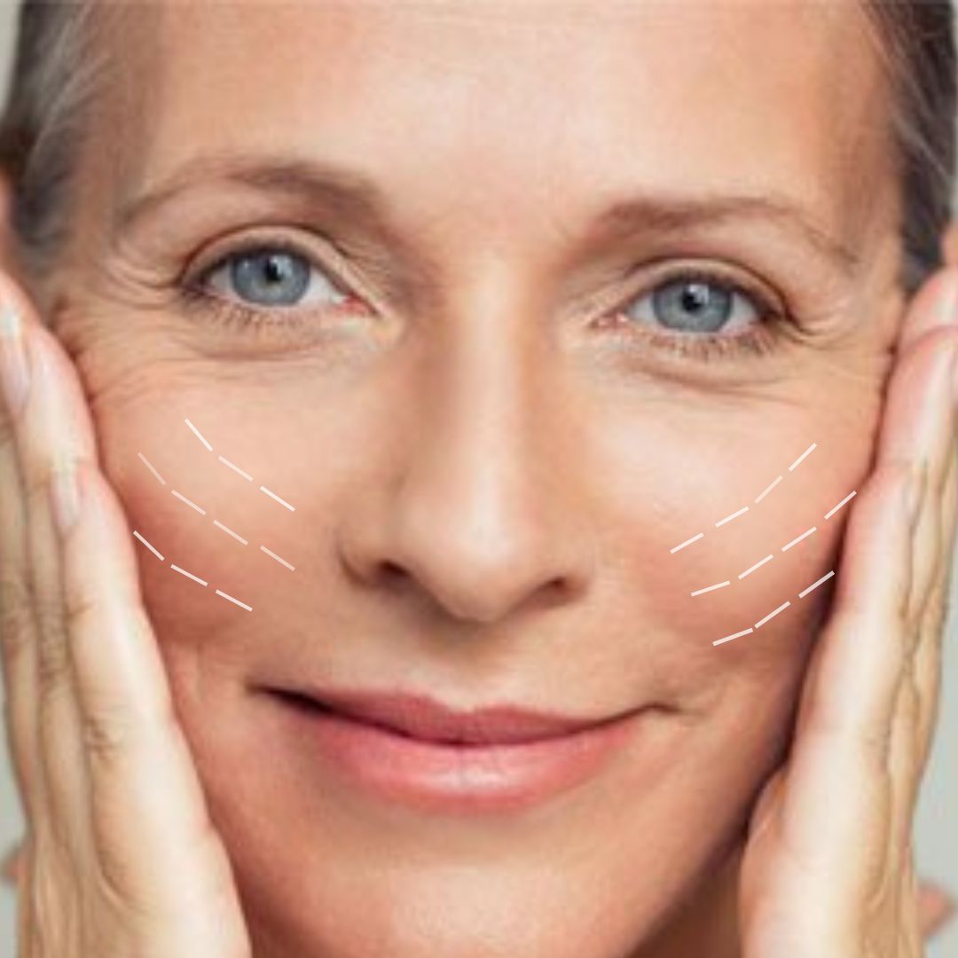 Sculptra Facial - Divali Clinic